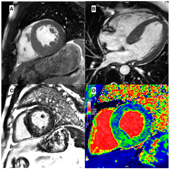 Cardiac Magnetic Resonance in HCM Phenocopies: From Diagnosis to Risk ...