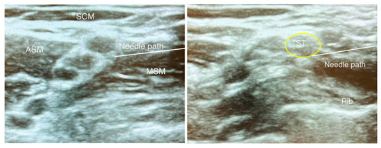 Regional Anesthesia Techniques for Shoulder Surgery in High-Risk ...