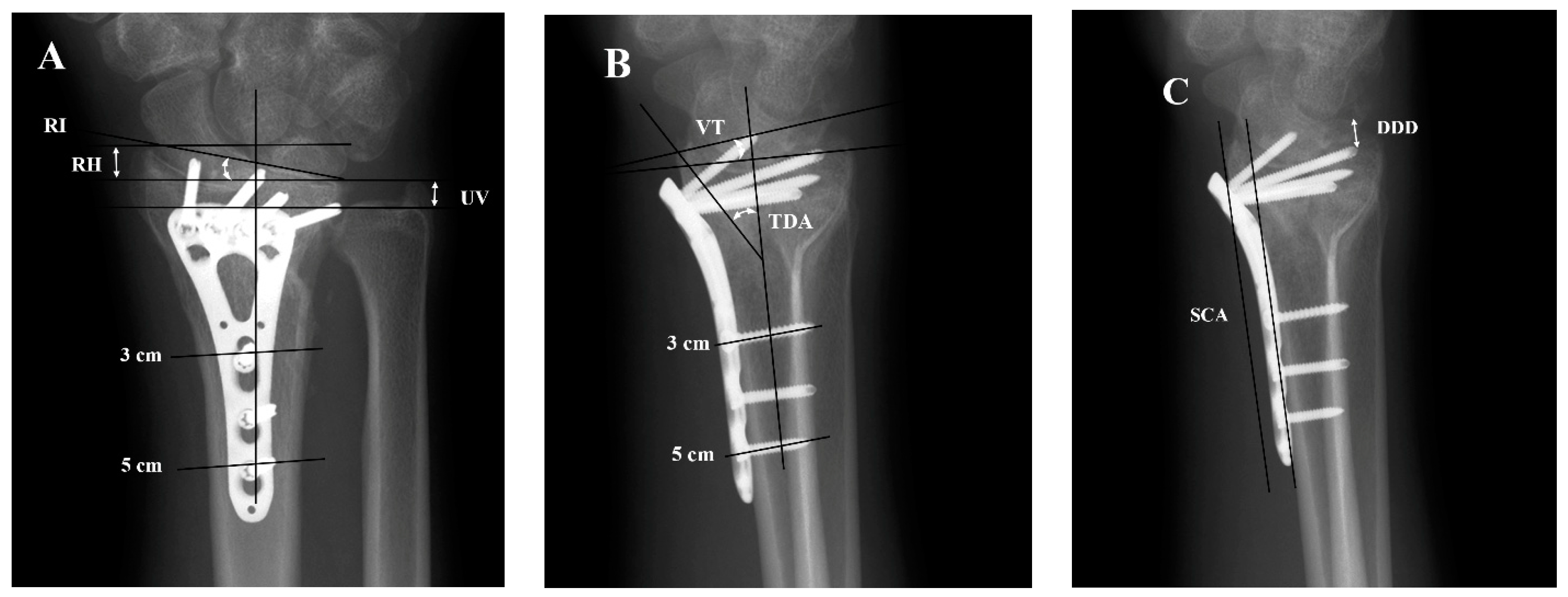Locking Screws Distal Radius Fracture At Qiana Flowers Blog