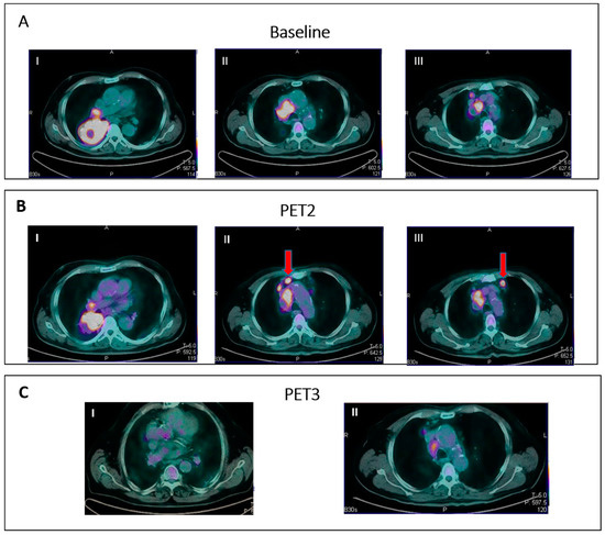Assessment of Response to Immunotherapy in Patients with Hodgkin Lymphoma: Towards Quantifying ...
