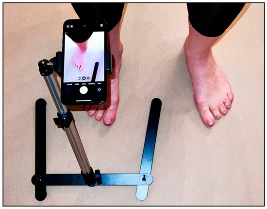 The Controversial Definition of Normal Toe Alignment