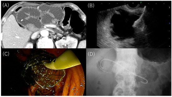 Endoscopic Ultrasound-Guided Gastrojejunostomy for Malignant Afferent ...