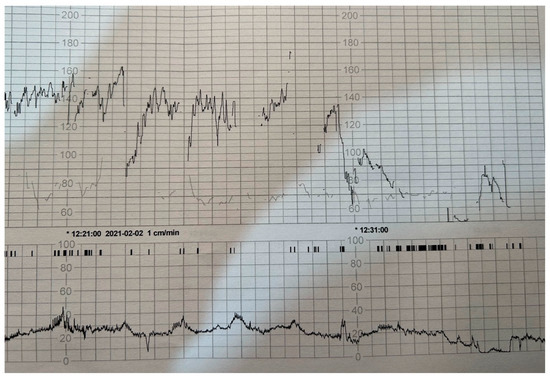 Unexpected Uterine Rupture—A Case Report, Review of the Literature and ...