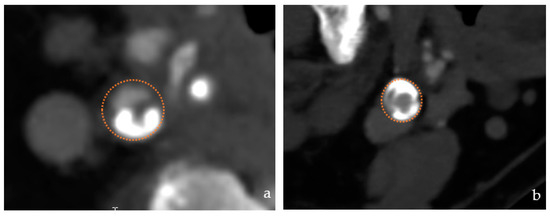 Patient Selection Criteria and Procedural Standardization for Carotid ...