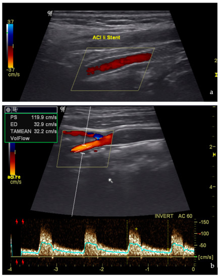 Patient Selection Criteria and Procedural Standardization for Carotid ...