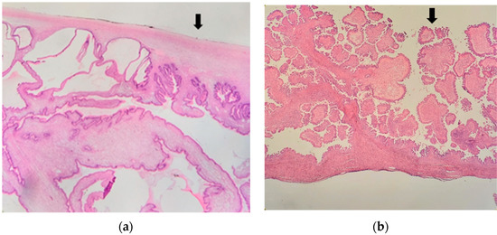 Do Exophytic and Endophytic Patterns in Borderline Ovarian Tumors Have ...