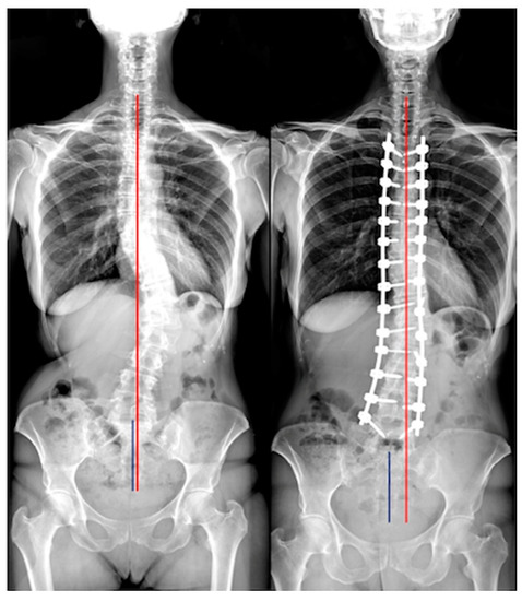 Independent Risk Factors of Postoperative Coronal Imbalance after Adult ...