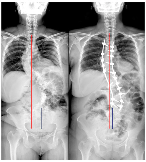 Independent Risk Factors of Postoperative Coronal Imbalance after Adult ...