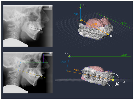 The Position of the Virtual Hinge Axis in Relation to the Maxilla in ...