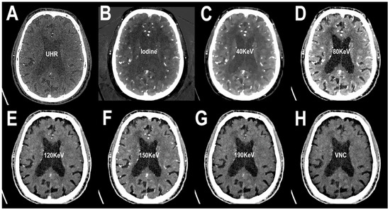Dual Source Photon-Counting Computed Tomography—Part II: Clinical ...