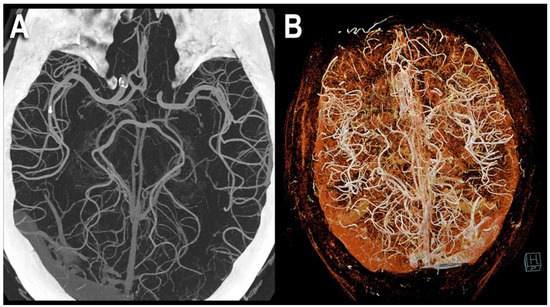 Dual Source Photon-Counting Computed Tomography—Part II: Clinical ...