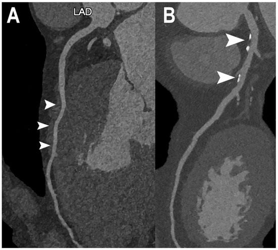 Dual-Source Photon-Counting Computed Tomography—Part I: Clinical ...