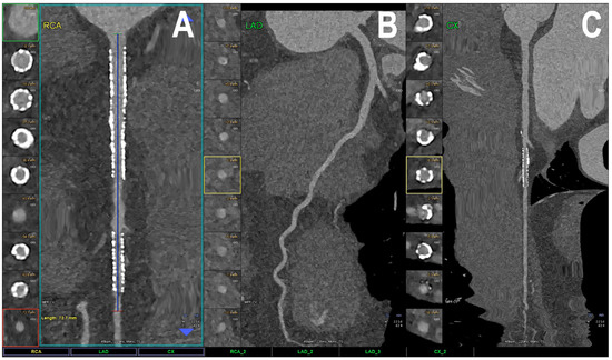 Dual-Source Photon-Counting Computed Tomography—Part I: Clinical ...