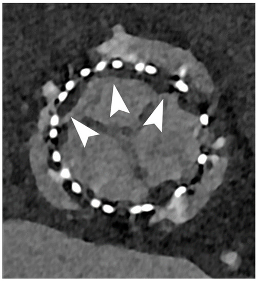 Dual-Source Photon-Counting Computed Tomography—Part I: Clinical ...