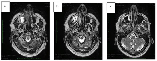 Guided Zygomatic Implantology for Oral Cancer Rehabilitation: A Case Report