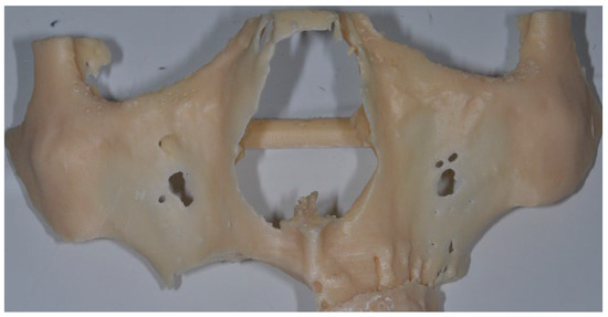 Guided Zygomatic Implantology for Oral Cancer Rehabilitation: A Case Report
