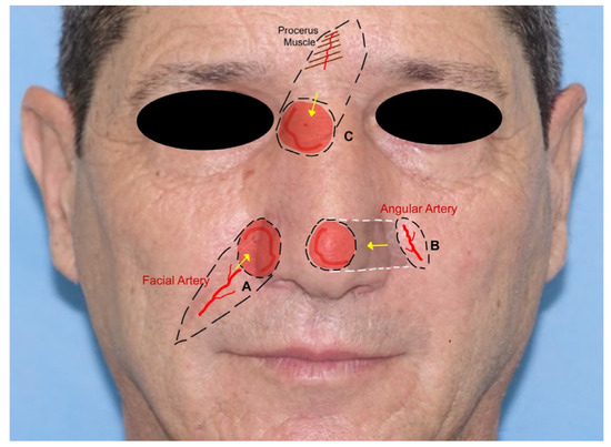 Locoregional Flaps for the Reconstruction of Midface Skin Defects: A ...