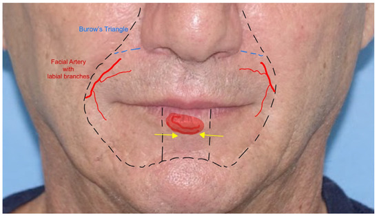 Locoregional Flaps for the Reconstruction of Midface Skin Defects: A ...