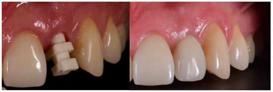 Minimally Invasive Treatment of Lateral Incisors with Guided One-Piece ...