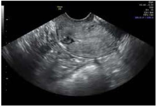 Outcomes of Laparoscopic Cesarean Scar Defect Repair: Retrospective and ...