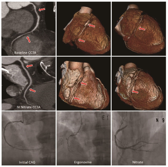 Role of Dual-Acquisition Noninvasive Cardiac CT Imaging for the ...