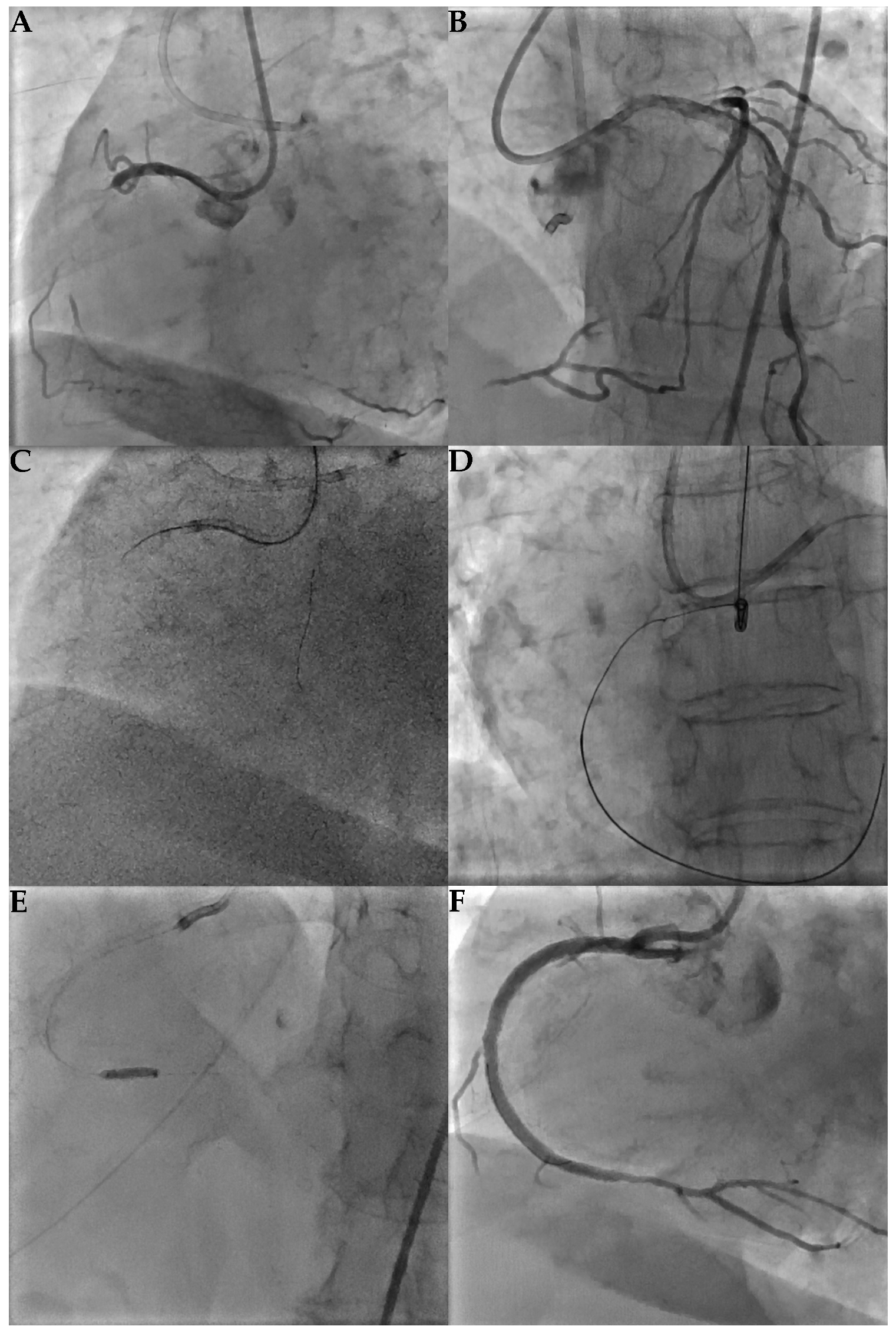 Percutaneous Coronary Intervention for Chronic Total Occlusion ...
