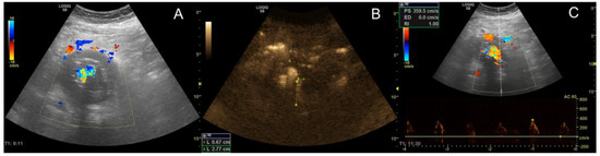 Endoleak Detection after Endovascular Aortic Repair via Coded ...