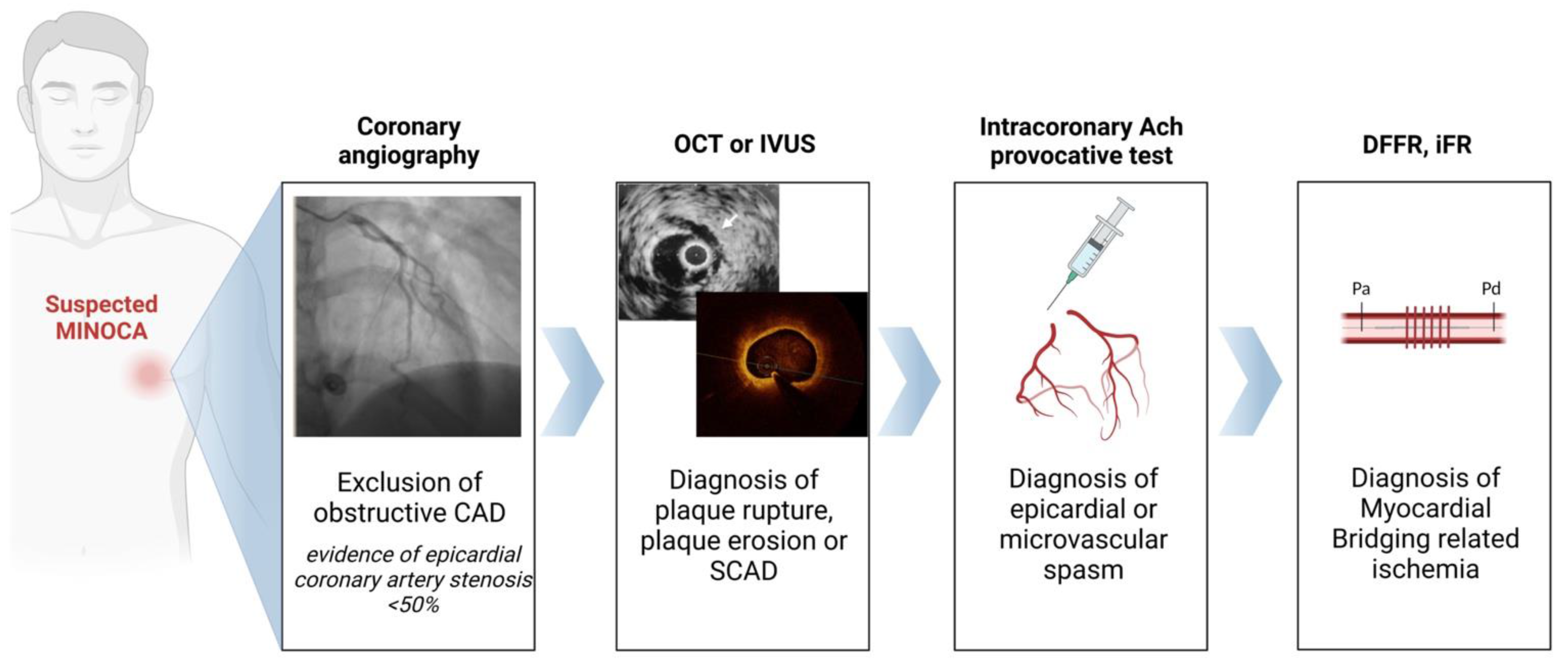 Myocardial Bridge Myocardial Bridge