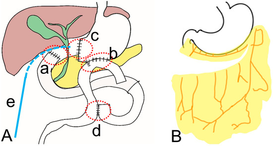 Treatment and Prevention of Postoperative Leakage after Gastrectomy for ...
