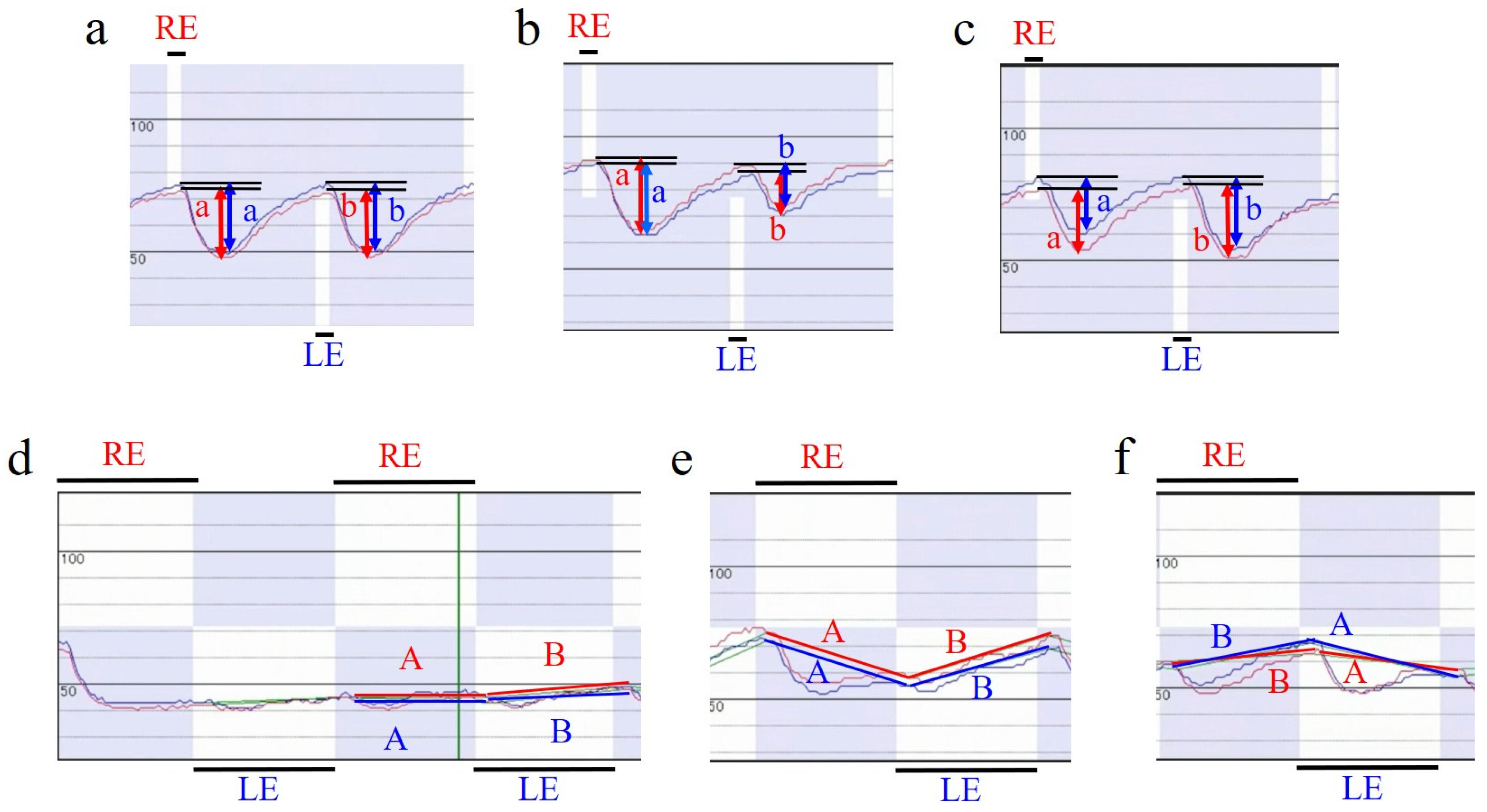 Detection of Relative Afferent Pupillary Defect and Its Correlation ...