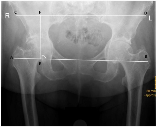 The Direct Anterior Approach (DAA) as a Standard Approach for Total Hip ...