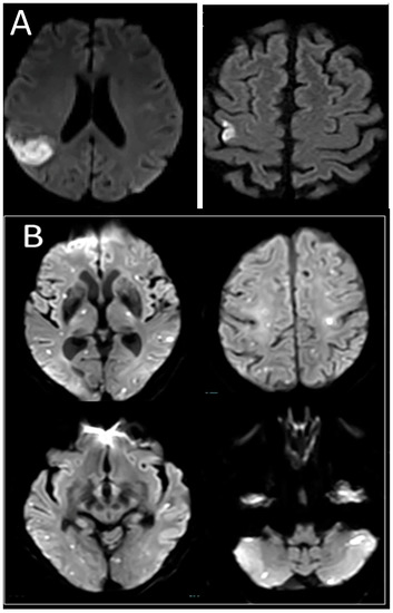 Characteristics of Multiple Acute Concomitant Cerebral Infarcts Involving Different Arterial ...