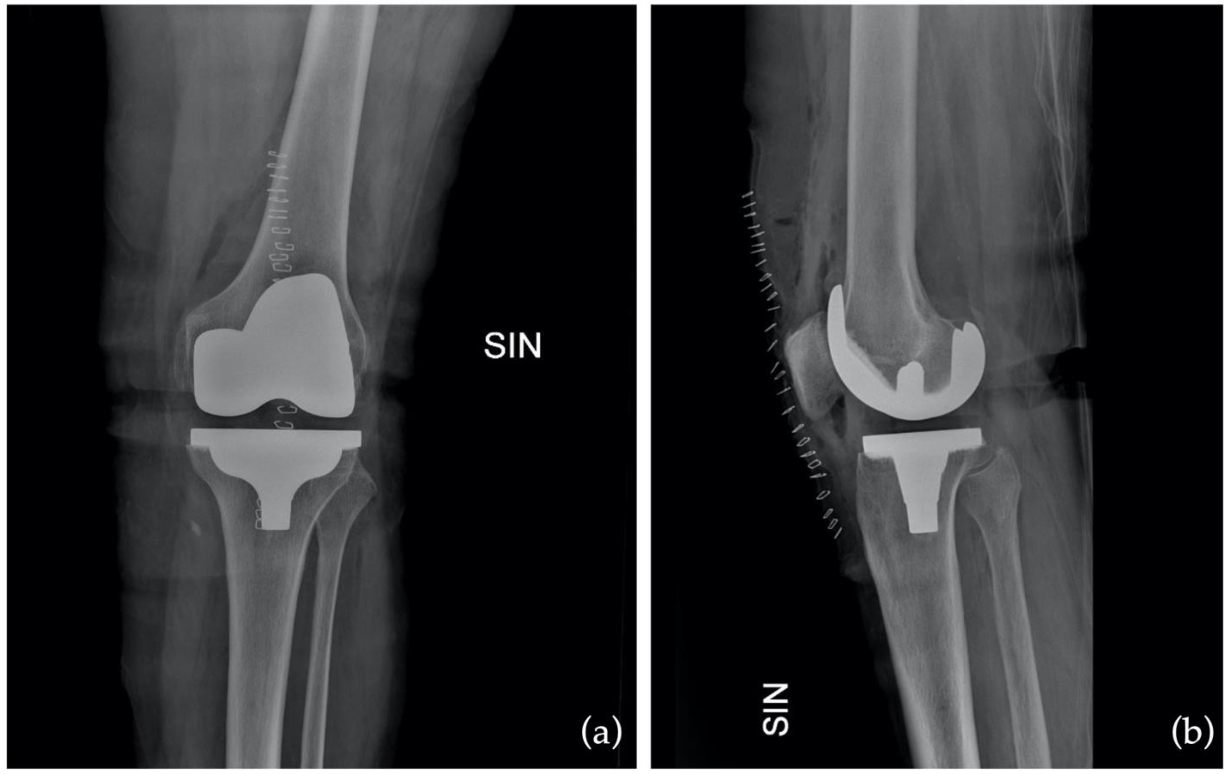 Analysis of Short-Term Clinical and Functional Outcomes in Patients ...