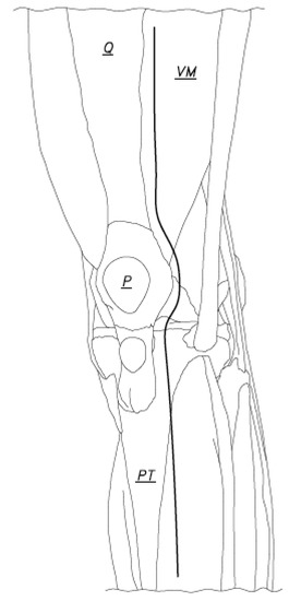 Water-Tight Arthrotomy Joint Closure of Modified Intervastus Approach ...