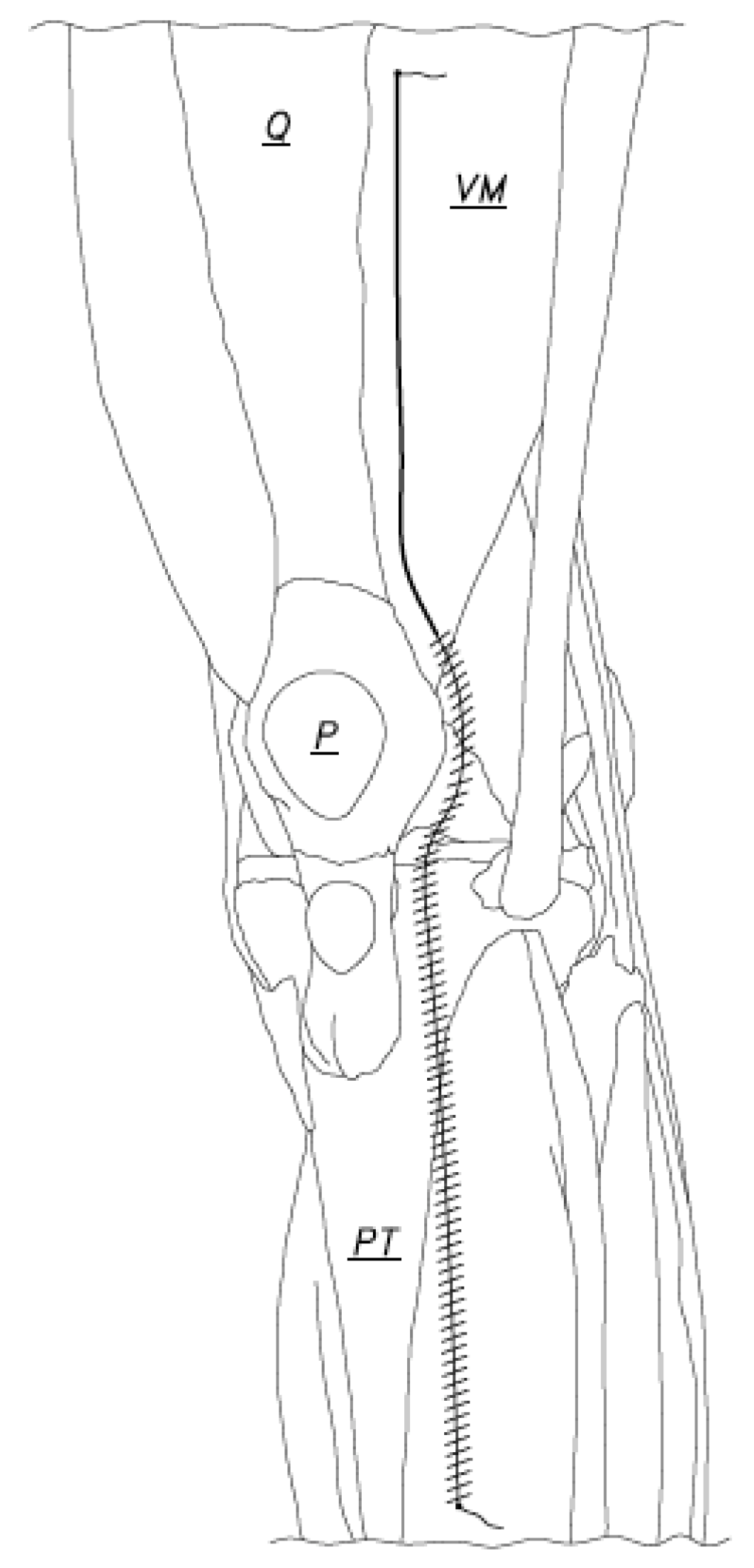 Water-Tight Arthrotomy Joint Closure of Modified Intervastus Approach ...