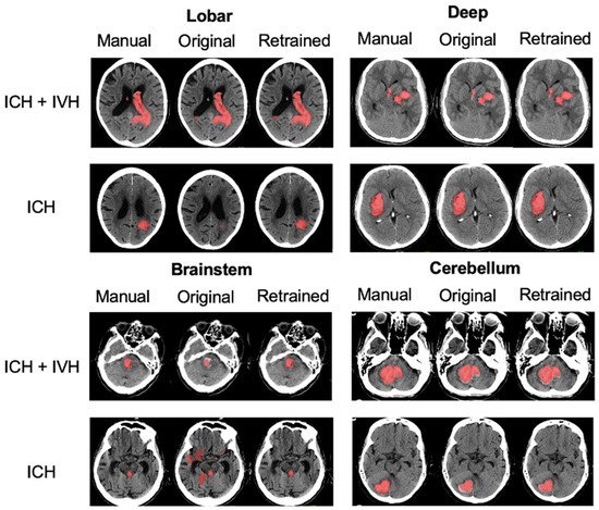 External Validation and Retraining of DeepBleed: The First Open-Source 3D Deep Learning Network ...