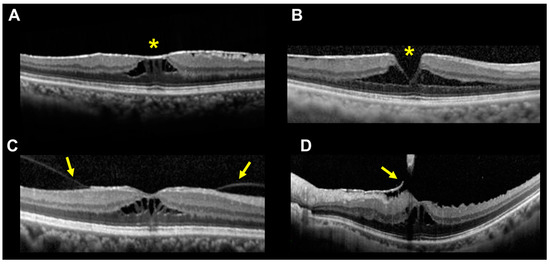 Comparisons of Clinical Characteristics and Surgical Outcomes of ...