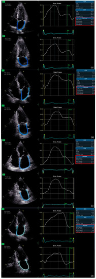 Value of Left Atrial Strain in Predicting Recurrence after Atrial ...