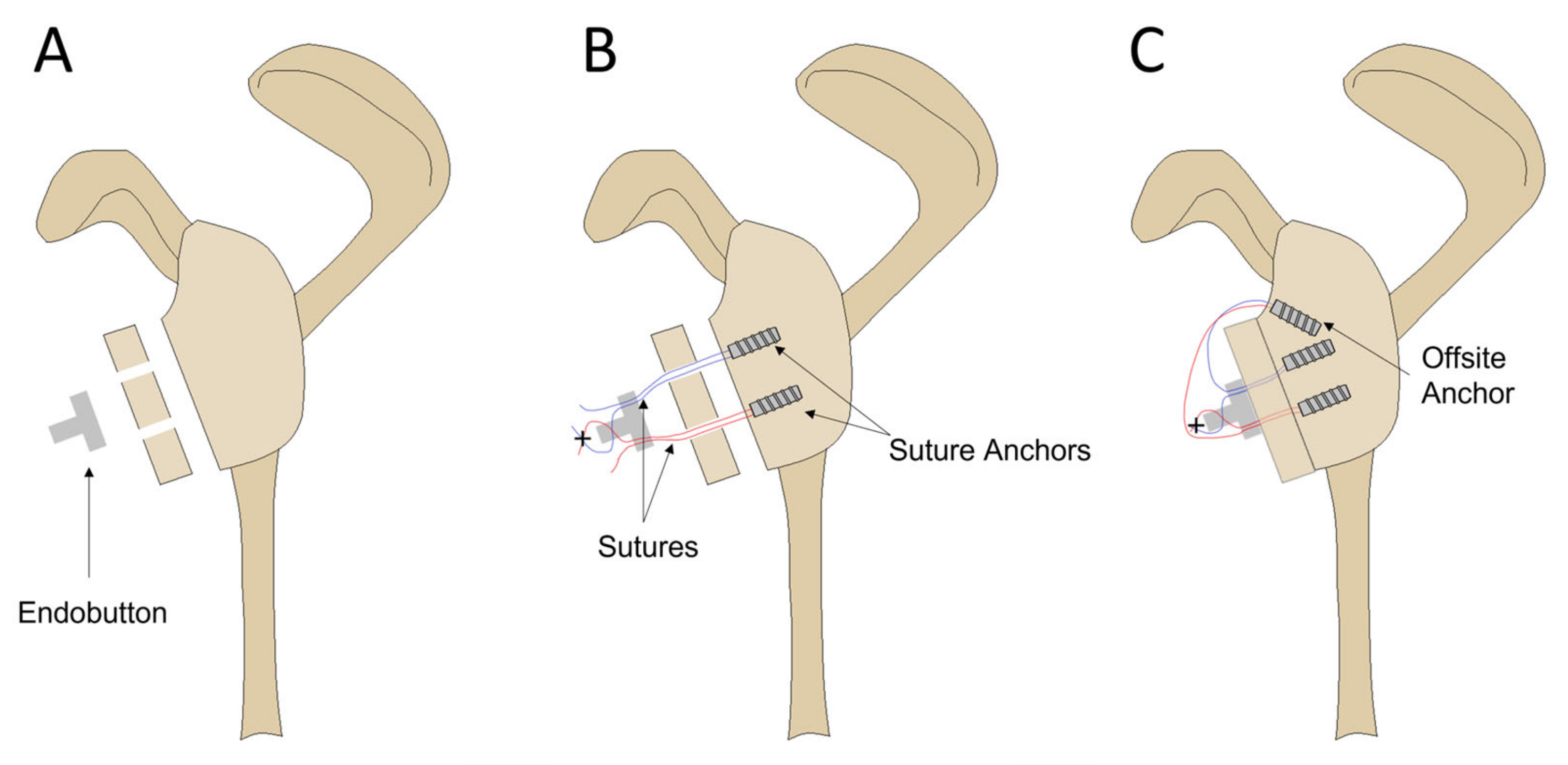 Acromion and Distal Clavicle Grafts for Arthroscopic Glenoid Reconstruction