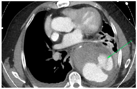 Single-Center Retrospective Subgroup Analysis of “Primary Aortic ...