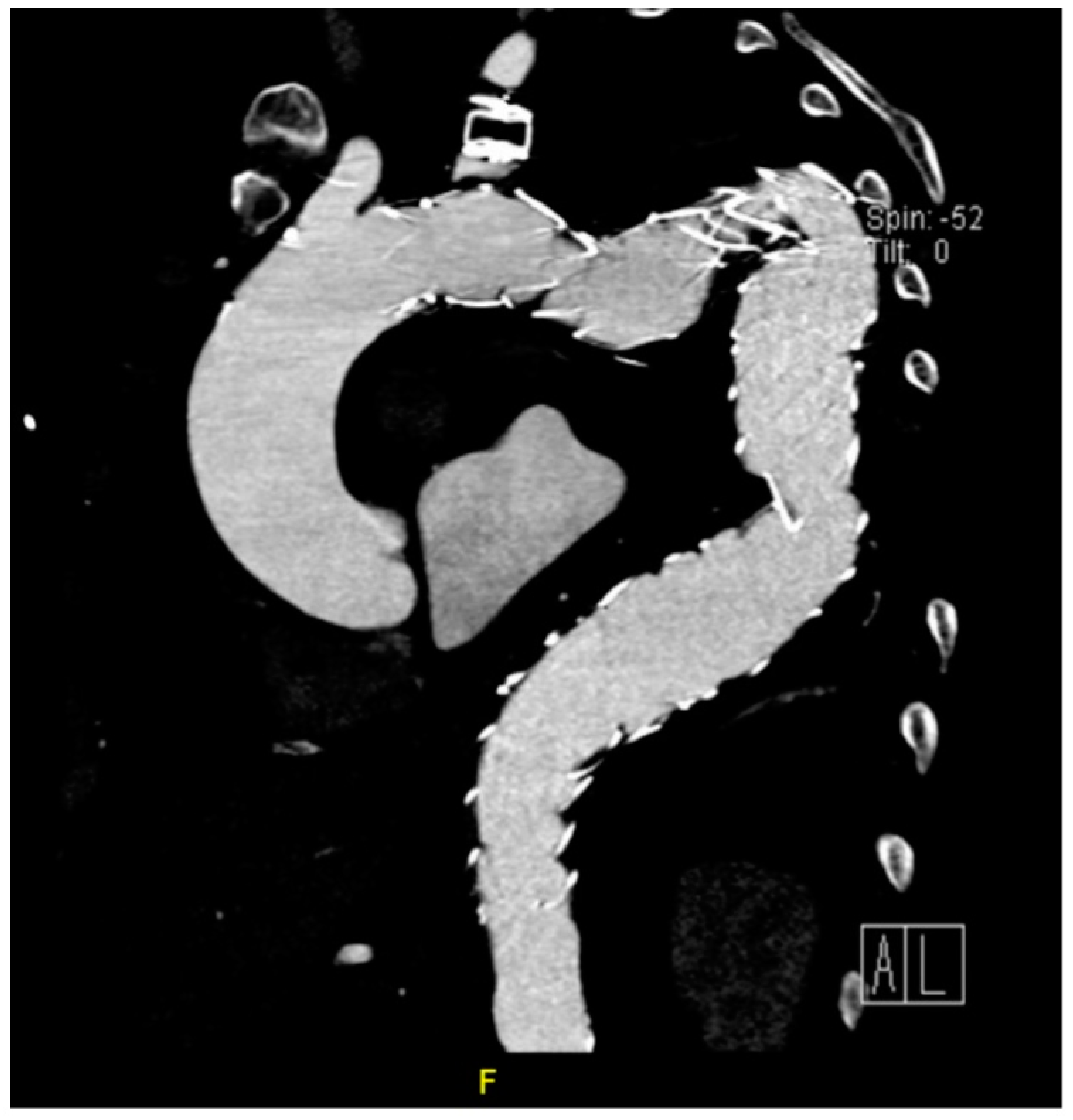 Single-Center Retrospective Subgroup Analysis of “Primary Aortic ...