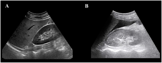 Use of Automated Machine Learning for Classifying Hemoperitoneum on ...