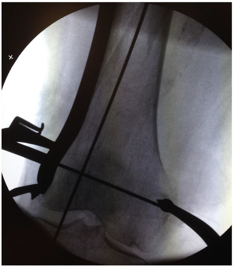 Using a Traction Table for Fracture Reduction during Minimally Invasive ...