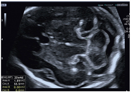 Fetal Cerebellar Area: Ultrasound Reference Ranges at 13–39 Weeks of ...