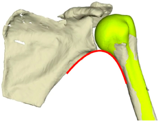 Three-Dimensional Measurement of Proximal Humerus Fractures ...