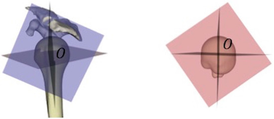 Three-Dimensional Measurement of Proximal Humerus Fractures ...