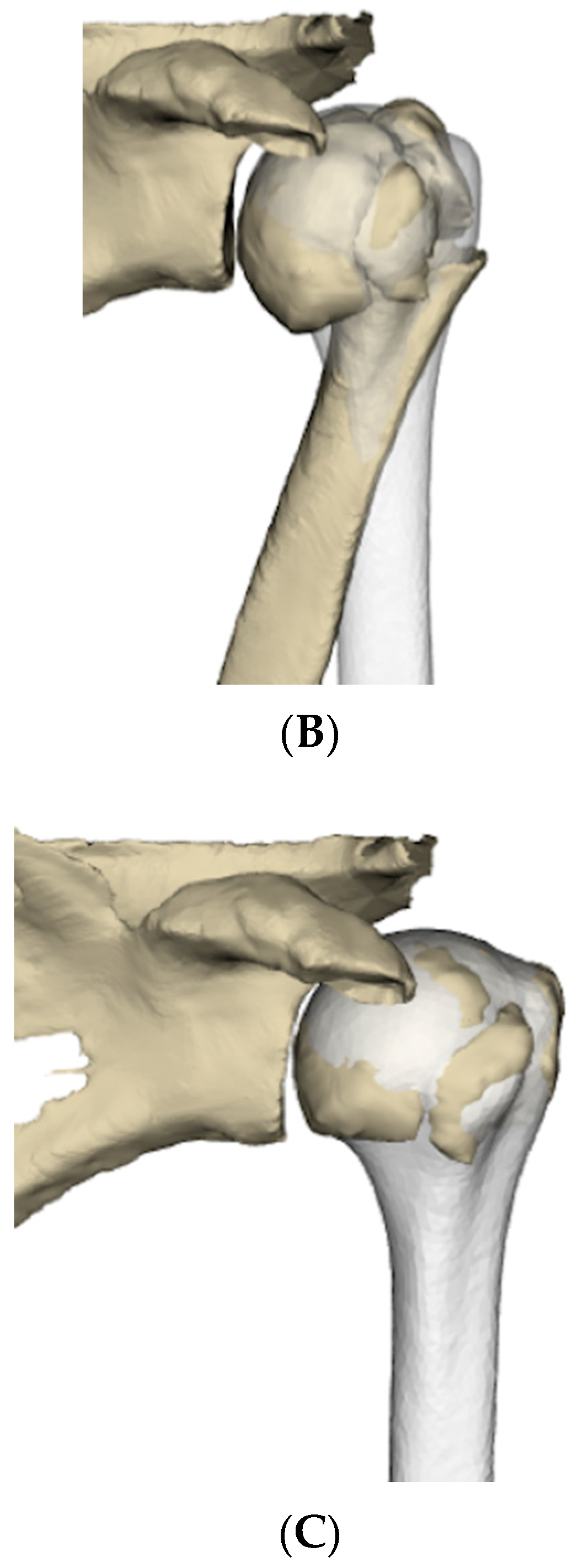 Three-Dimensional Measurement of Proximal Humerus Fractures ...
