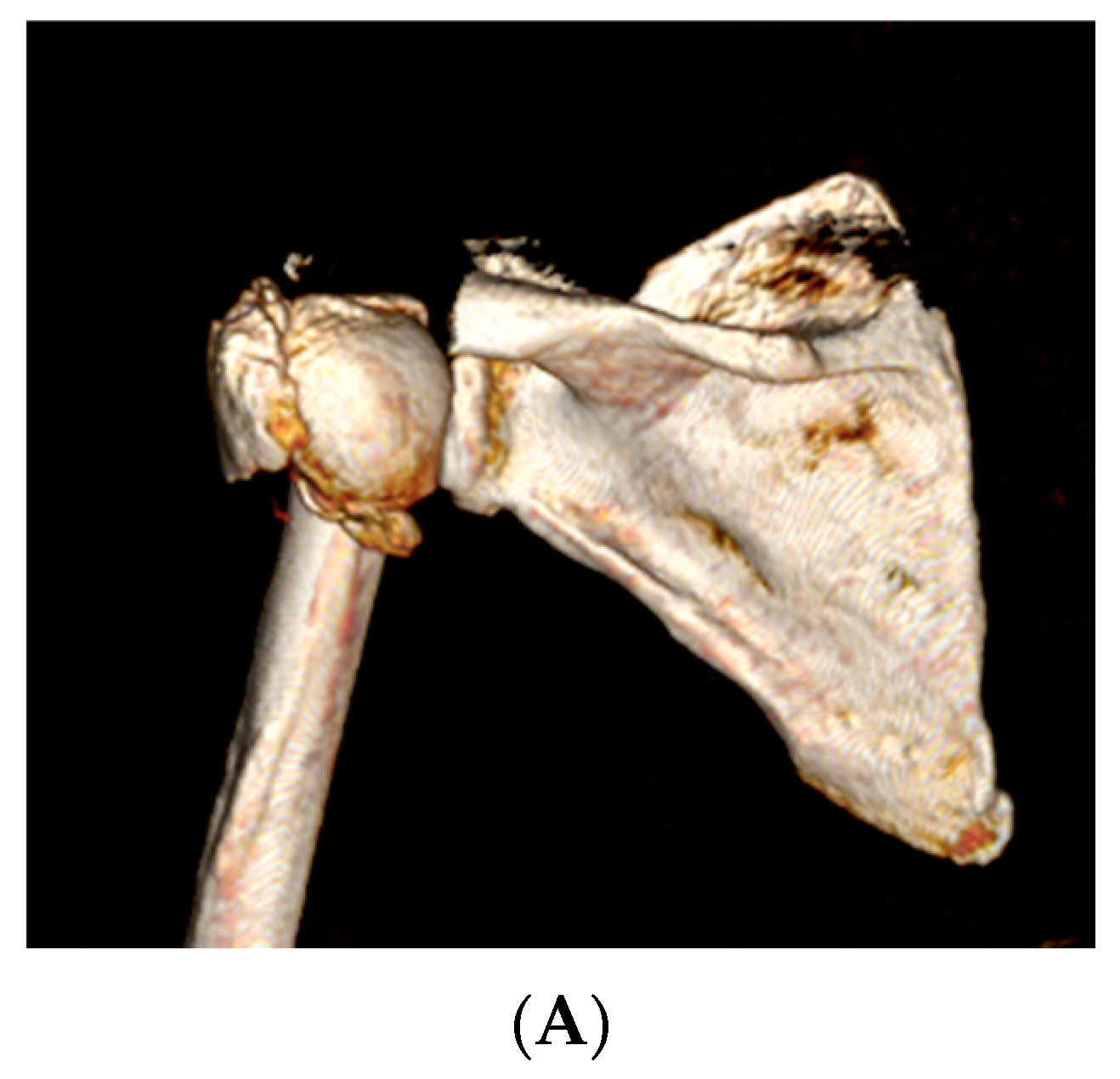Three-Dimensional Measurement of Proximal Humerus Fractures ...