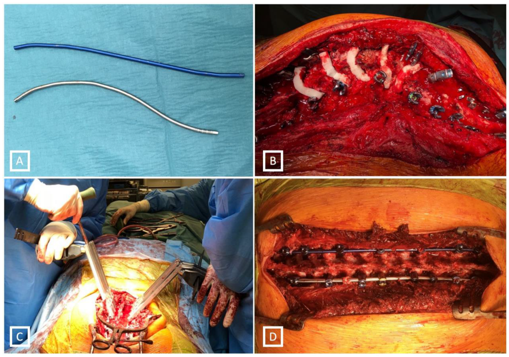 Direct Vertebral Rotation (DVR) Does Not Improve Clinical and ...