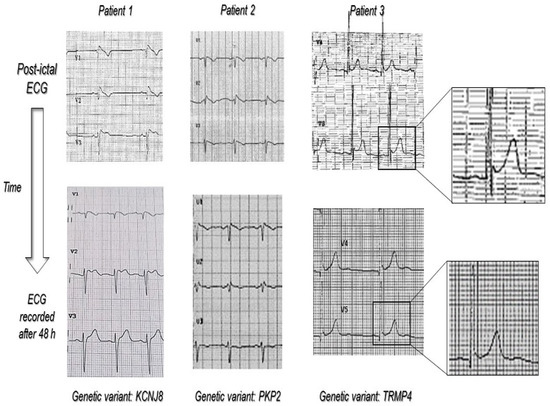 Electrocardiogram Changes in the Postictal Phase of Epileptic Seizure ...